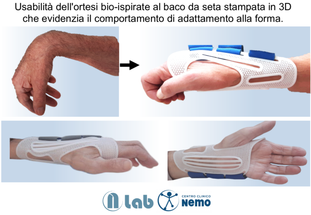 Da NeMO Lab un tutore “polso-mano” che aiuta le persone con patologie neuromuscolari – Informare ...